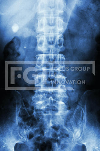 유토이미지 | film x-ray KUB ( Kidney - ureter - bladder ) show right renal ...